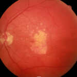 Age-related macular degeneration (AMD) - Retina Australia