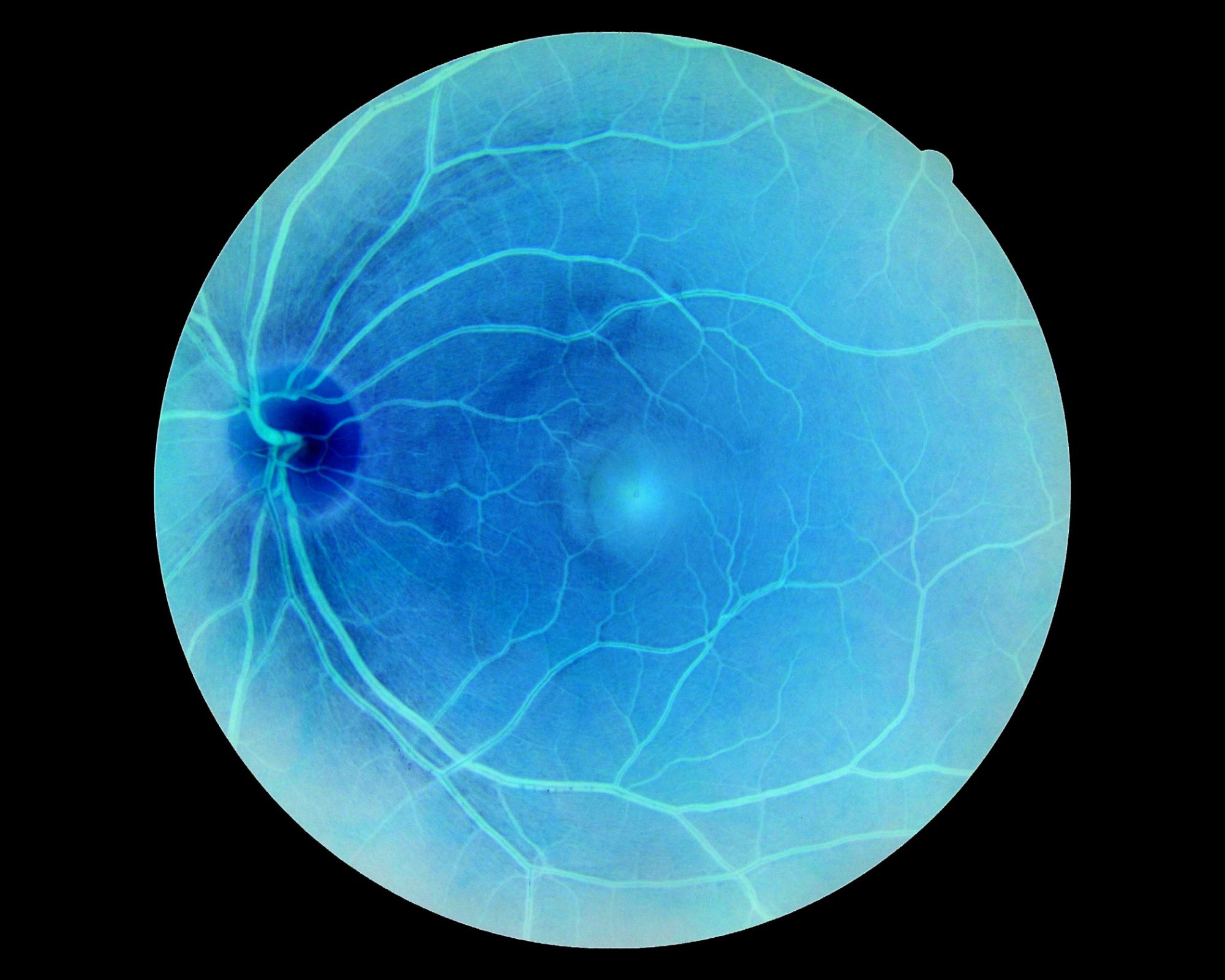Inherited retinal disease - Retina Australia