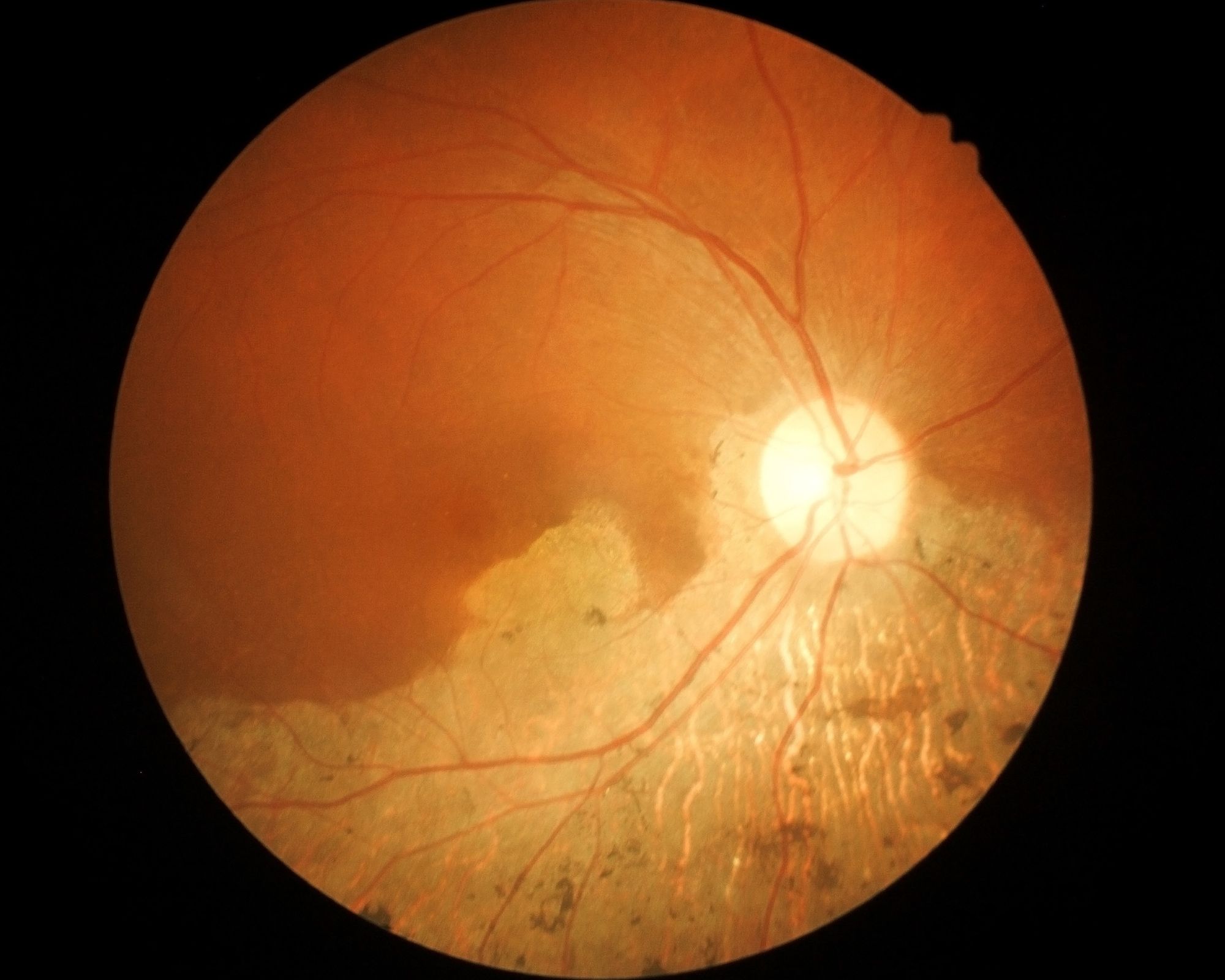 Age-related Macular Degeneration (AMD) - Retina Australia