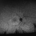 Stargardt disease - Retina Australia