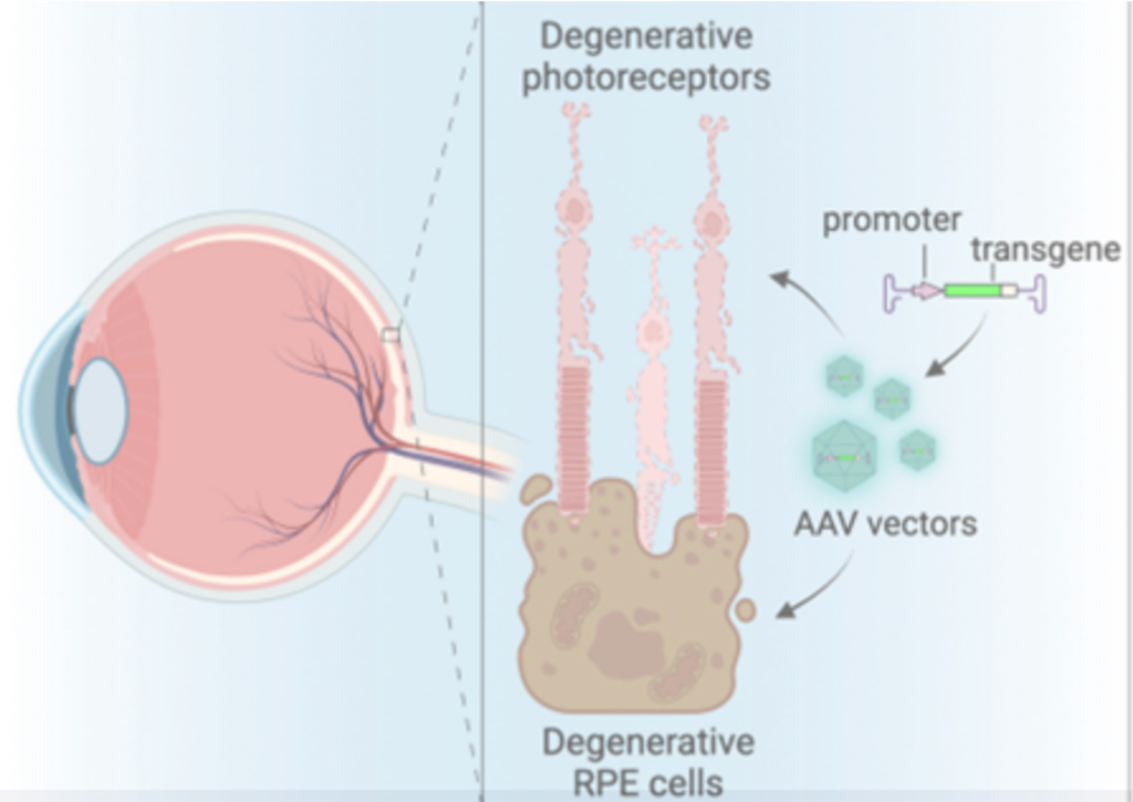 AAV-Based Gene Therapy for Retinal Diseases: A 2025 update - Retina ...